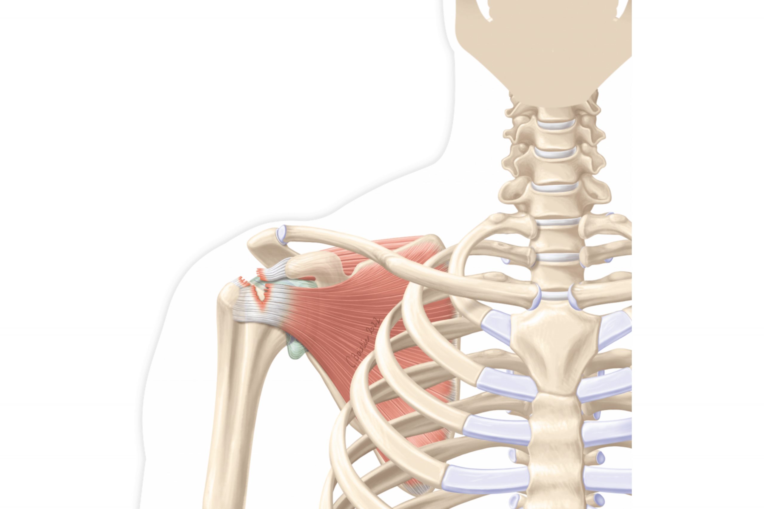 Rupture du tendon du supra-épineux | Drs Agout, Commeil & Lavignac